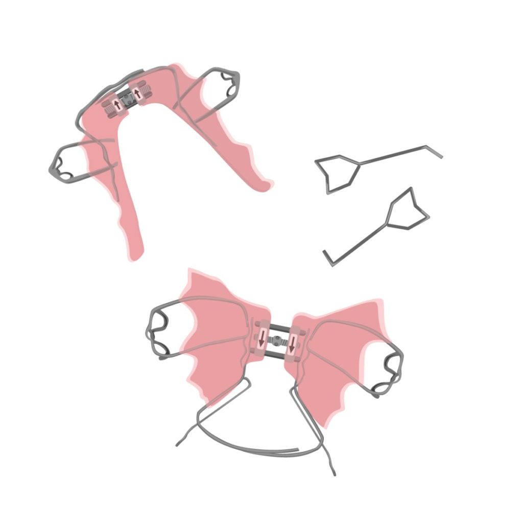 Everything You Need to Know About Palatal Expanders | Luv Braces